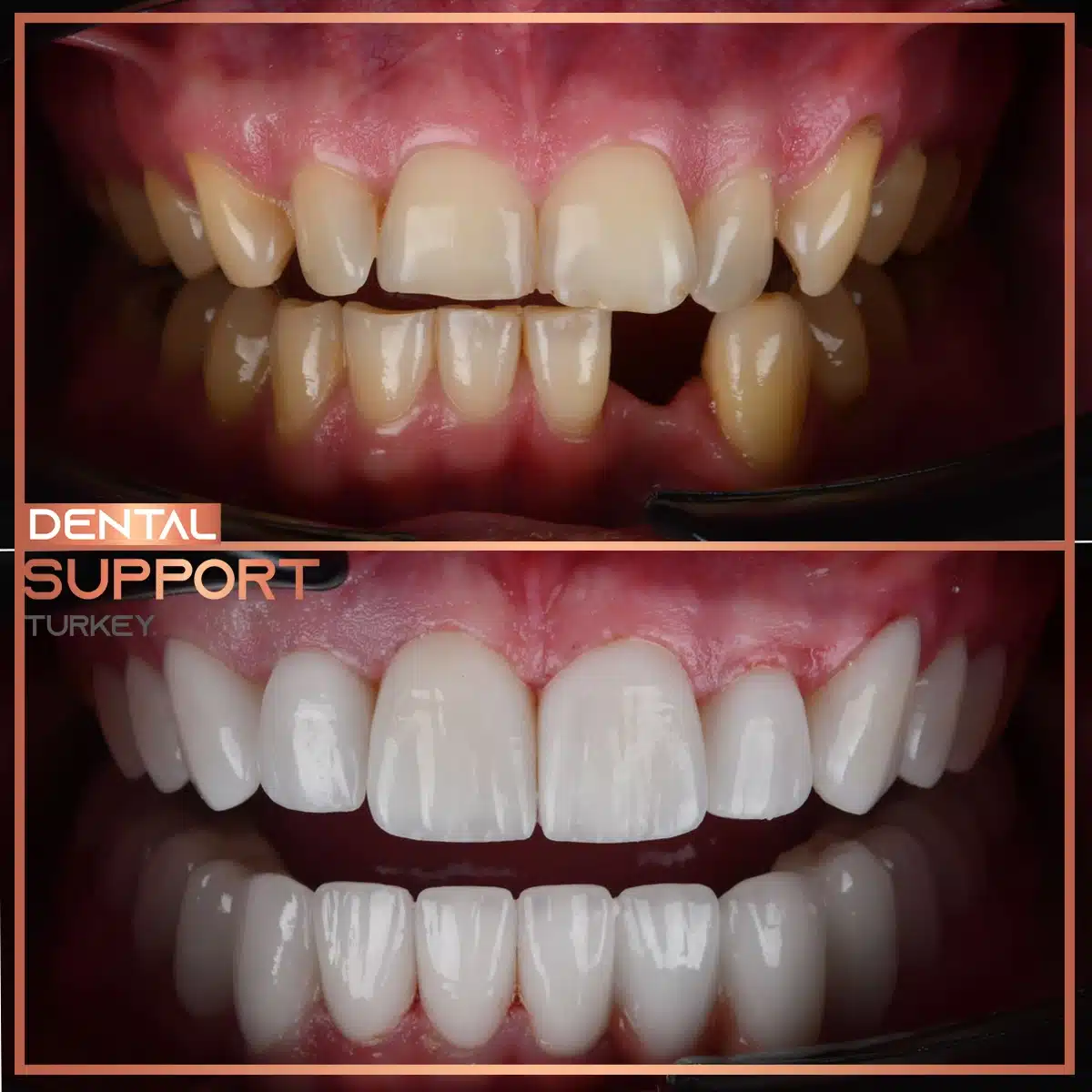Smile Gallery - Dental Support Turkey